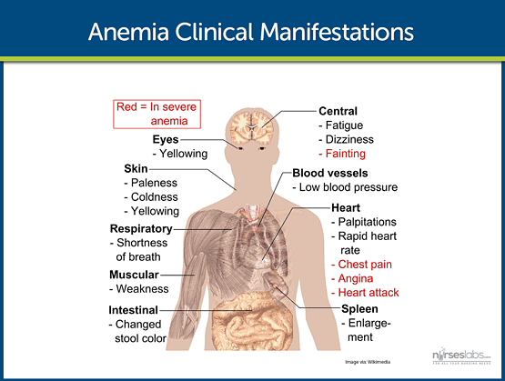 Anemia Nursing Care Management: A Study Guide