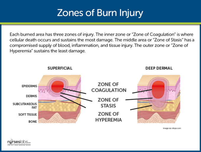 Burn Injury Nursing Care Management and Study Guide
