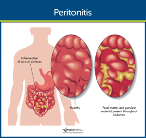 Peritonitis Nursing Care Management and Study Guide