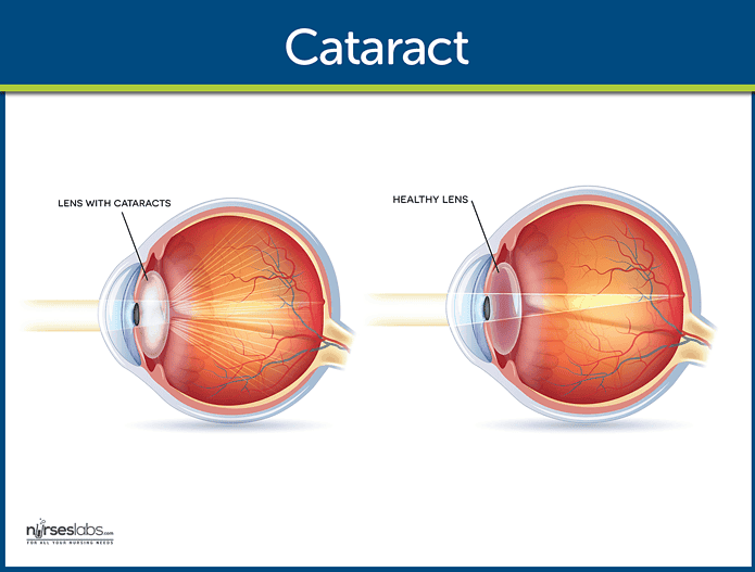 Cataract Nursing Care Management: Study Guide for Nurses