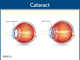 Cataract Nursing Care Management: Study Guide for Nurses