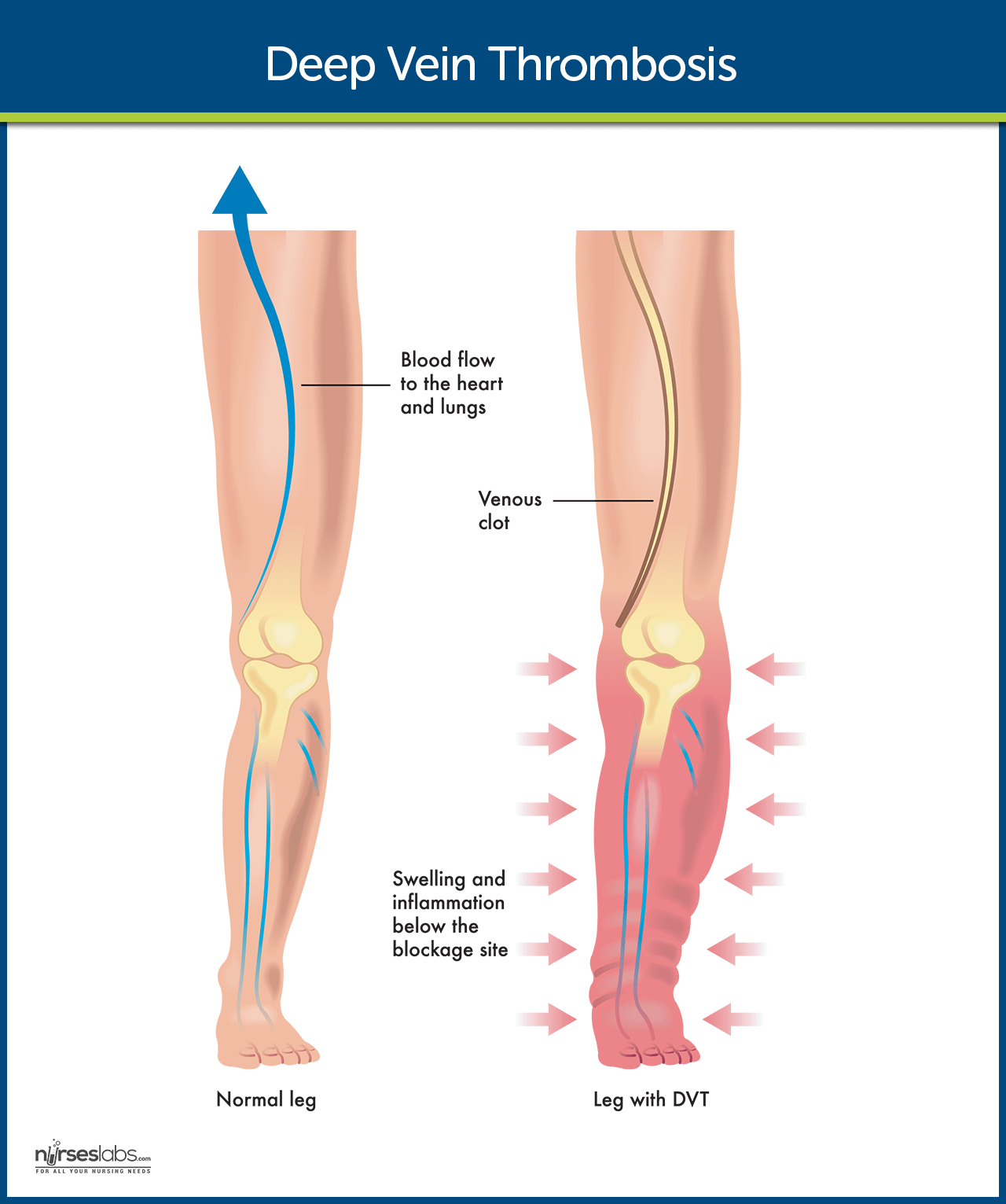 DVT DVT disambiguation JapaneseClass jp