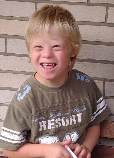 Down Syndrome (Trisomy 21) Nursing Care Planning and Management