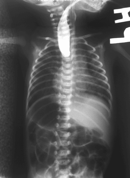 Tracheoesophageal Atresia Nursing Care Management: Study Guide - Nurseslabs