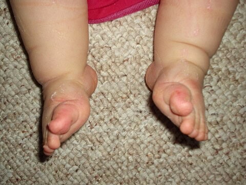 Congenital Talipes Equinovarus (Clubfoot) Nursing Care Management ...