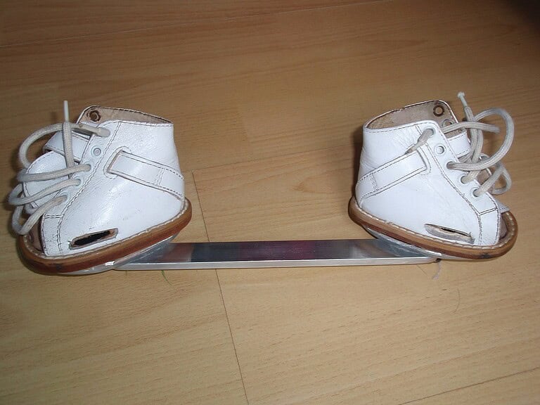 Congenital Talipes Equinovarus (Clubfoot) Nursing Care Management ...