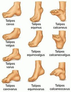 Congenital Talipes Equinovarus (Clubfoot) Nursing Care Management ...