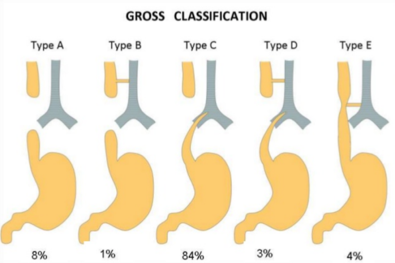 Tracheoesophageal Atresia Nursing Care Management: Study Guide - Nurseslabs