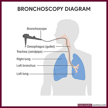 Bronchoscopy - Nursing Responsibilities - Nurseslabs