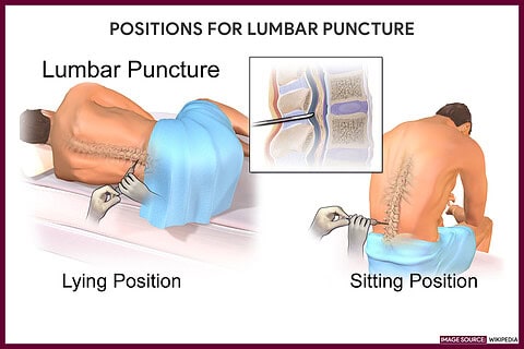 Lumbar Puncture (Spinal Tap) - Nursing Responsibilities - Nurseslabs