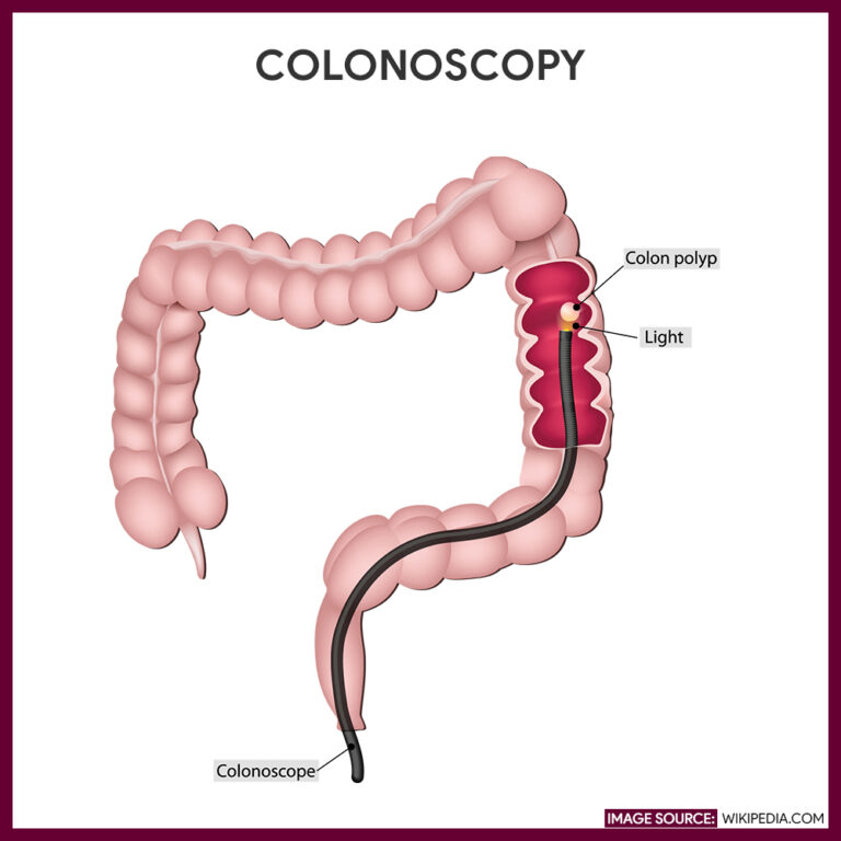 Colonoscopy - Nursing Responsibilities and Procedures - Nurseslabs