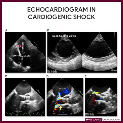 Echocardiogram - Nursing Responsibilities - Nurseslabs