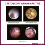 Cystoscopy - Nursing Responsibilities - Nurseslabs