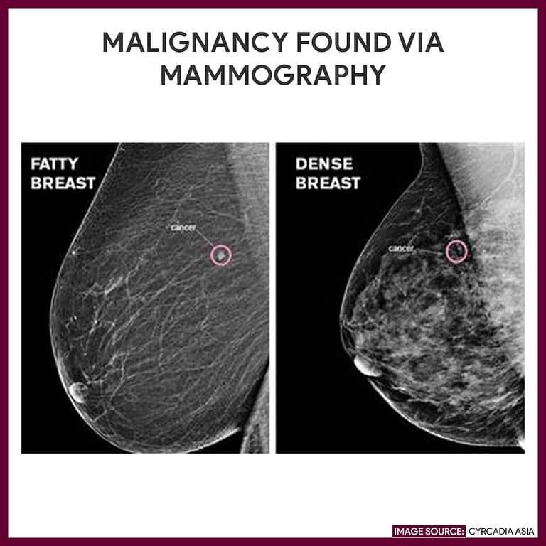 Mammogram Anatomy