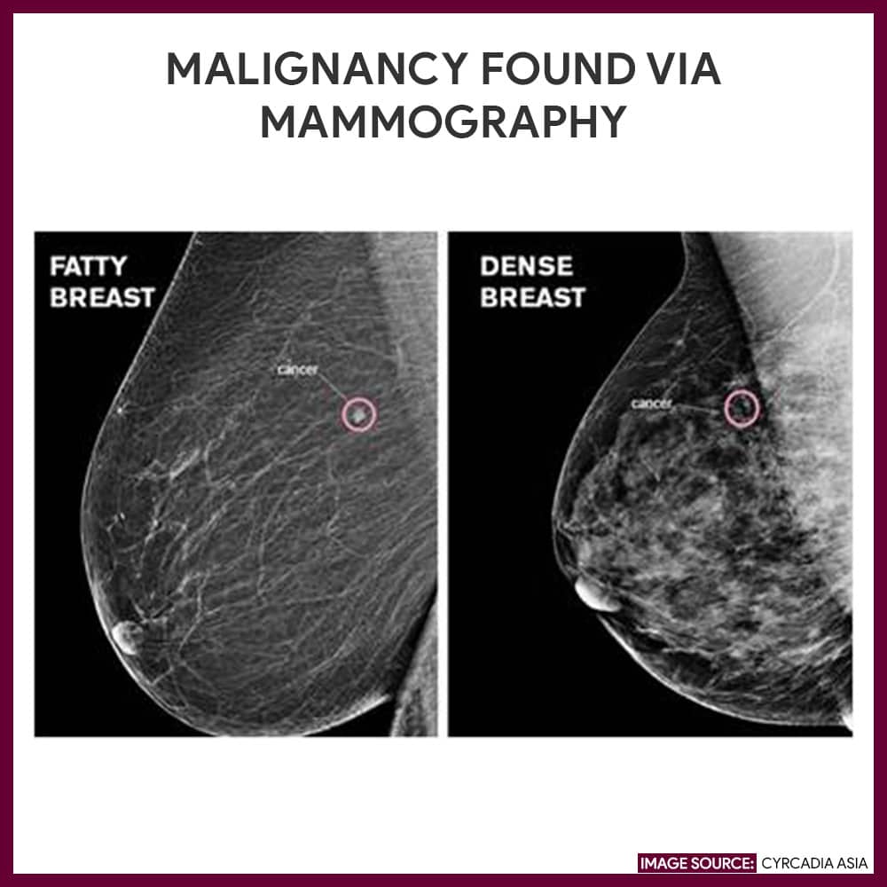 Abnormal Mammogram Abnormal Mammogram