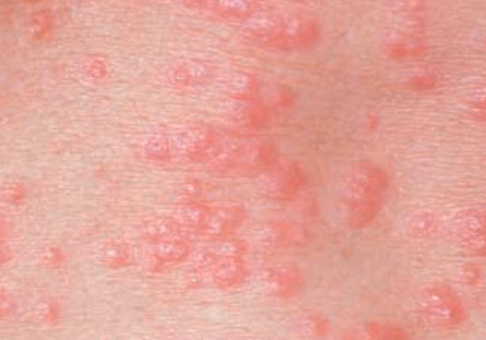 Scabies Nursing Management and Care Plan - Nurseslabs